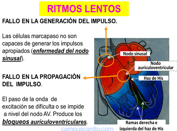 Características de los ritmos nodales de escape - CampusCardio
