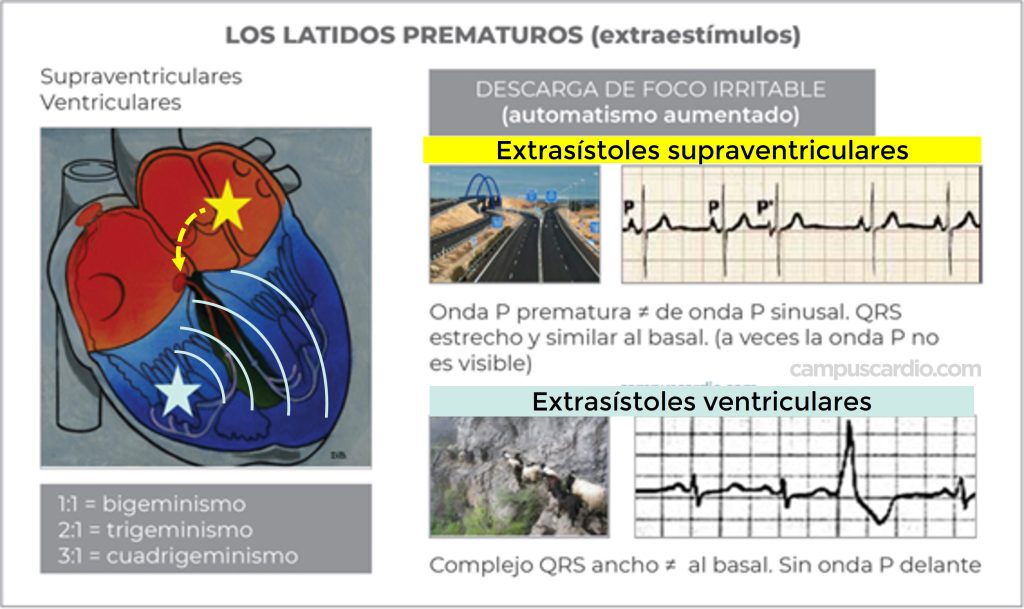 ¿Cuáles Son Los Síntomas De Las Extrasístoles Ventriculares Aisladas ...