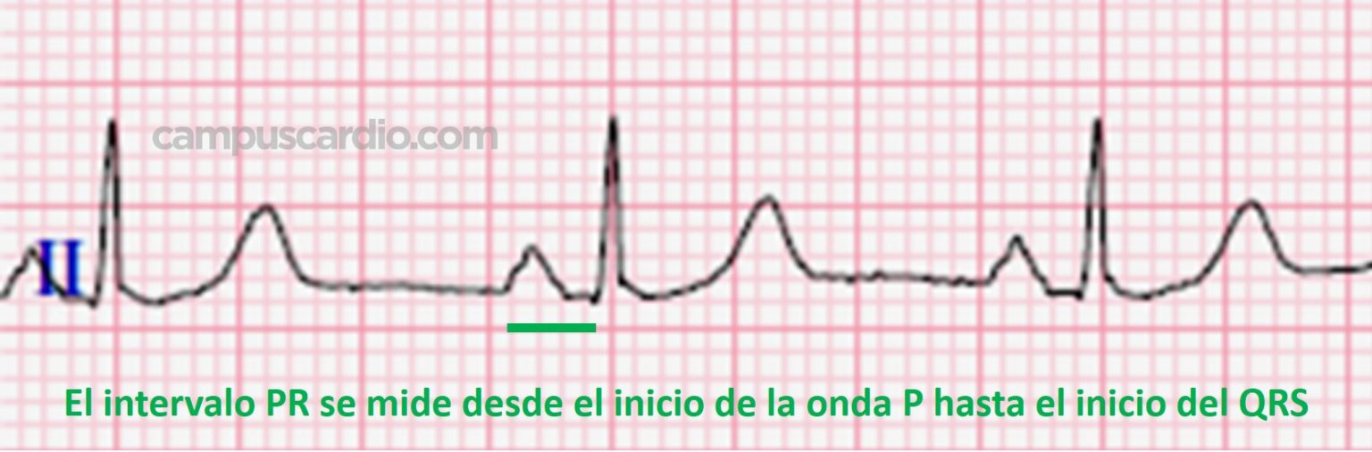 ¿Qué información da el intervalo el PR? - CampusCardio