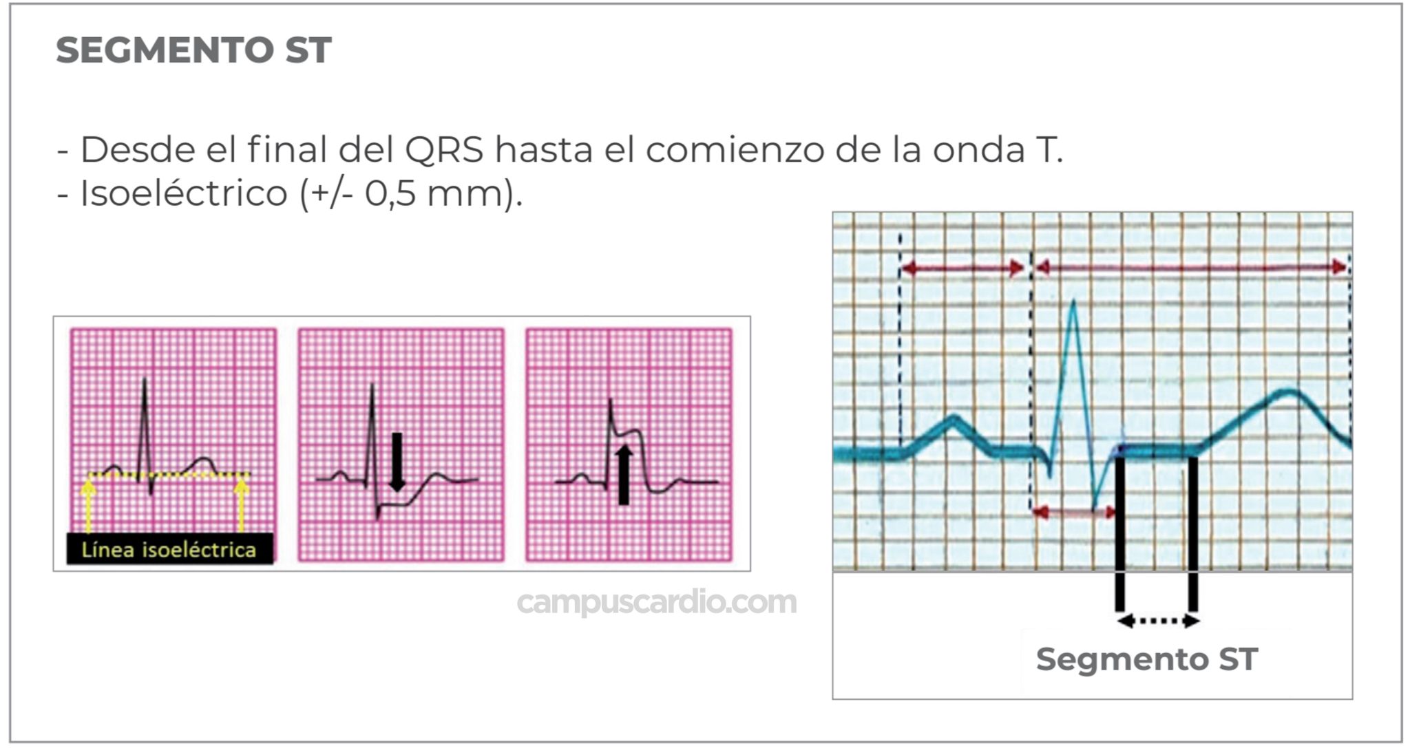 ¿Qué información nos da el segmento ST? - CampusCardio