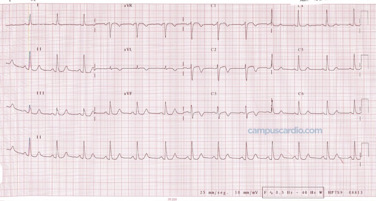 ¿Qué es el Síndrome de Wellens? - CampusCardio