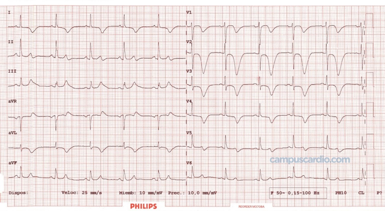 ¿Qué es el Síndrome de Wellens? - CampusCardio