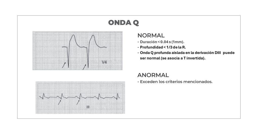 Signos electrocardiográficos en la cardiopatía isquémica - CampusCardio
