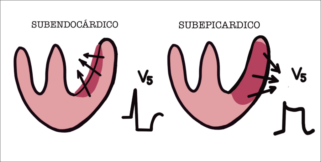 Signos Electrocardiográficos En La Cardiopatía Isquémica Campuscardio