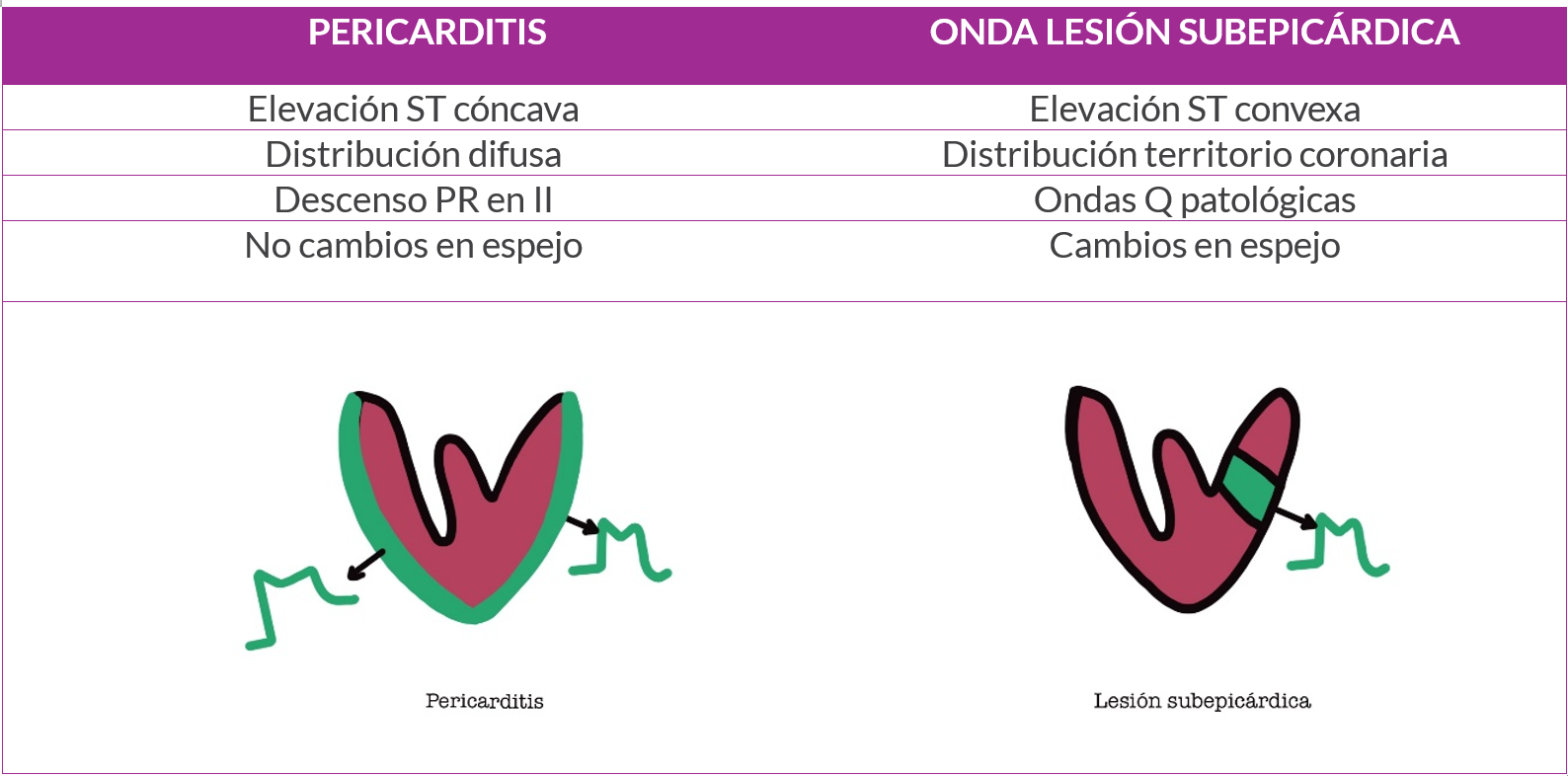 Signos electrocardiográficos en la PERICARDITIS AGUDA - CampusCardio