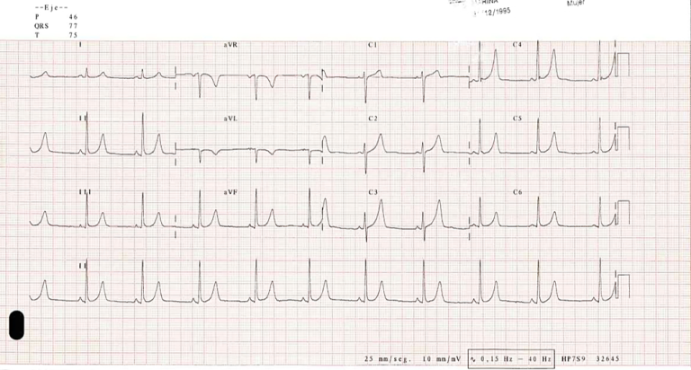 Preexcitación Ventricular y Arritmias Cardíacas. - CampusCardio